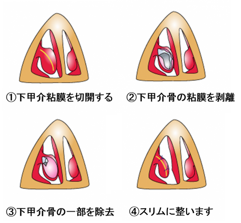 鼻中隔弯曲症の手術｜東京 石戸谷耳鼻咽喉科